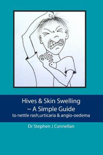 Hives and Skin Swelling ~ a Simple Guide : To Nettle Rash,urticaria and ...