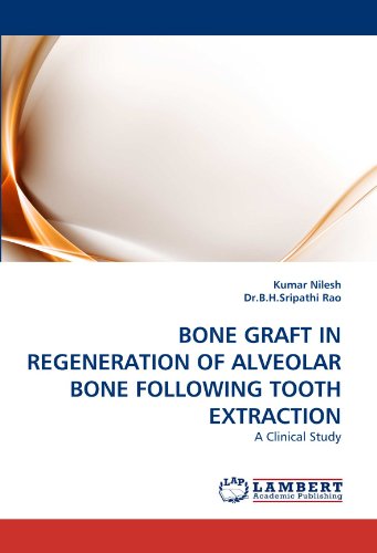 Bone Graft in Regeneration of Alveolar Bone Following Tooth Extraction ...